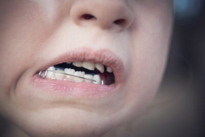 What Causes Crooked Teeth and How to Straighten Them